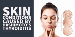 15 Skin Conditions Caused By Hashimoto’s & Hypothyroidism
