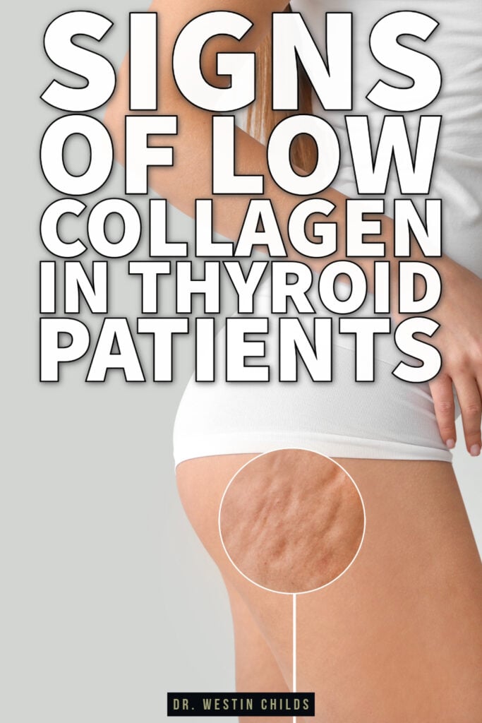 Signs of Low Collagen in Hypothyroid Patients